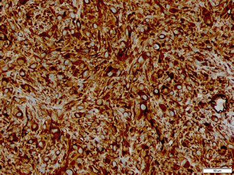This Is An Immunohistochemistry Stain Which Is Diffusely And Strongly