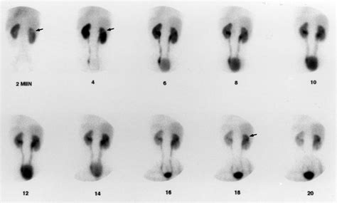 Diuretic Mag3 Scintigraphy F0 In Acute Pyelonephritis Regional