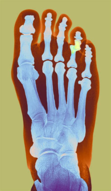 Dislocated Toe X Ray Photograph By Du Cane Medical Imaging Ltd Pixels