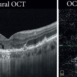 Stabilized CNV Structural OCT Shows The Absence Of Intraretinal Download Scientific Diagram