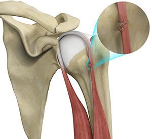 Proximal Biceps Tendon Rupture Centreville Va Biceps Tendon Tear