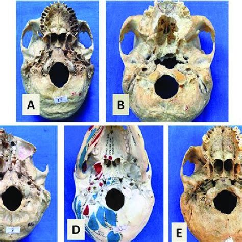 Various Shapes Of Foramen Magnum A Oval B Round C Tetragonal