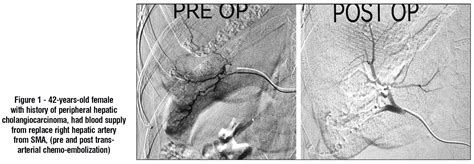Determining Risk Factors For Post Embolization Syndrome In Patients Undergoing Tace For Hepatic