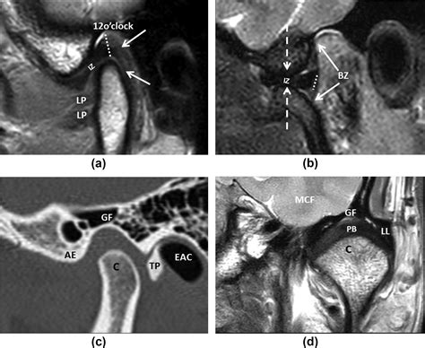 Imaging Of The Temporomandibular Joint Clinical Radiology