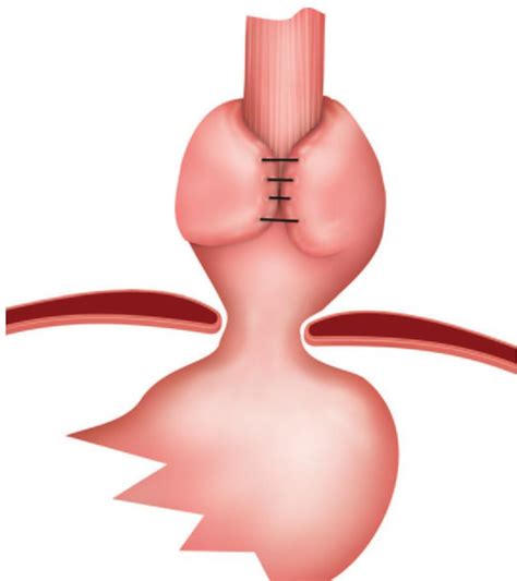 Pdf Imaging Findings Of Successful And Failed Fundoplication