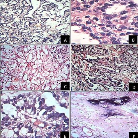 Histopathological Patterns Of Yst Areticular Growth Pattern H And E