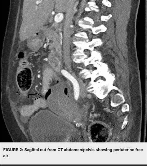 Figure 1 From Generalized Peritonitis Secondary To Perforated Uterine