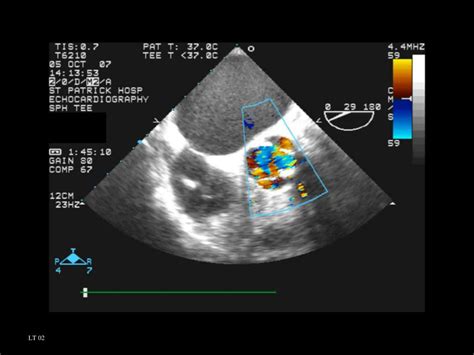 Ppt Trileaflet Aortic Valve Powerpoint Presentation Free Download
