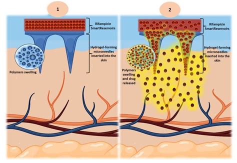 Novel Smartreservoirs For Hydrogel Forming Microneedles To Improve The