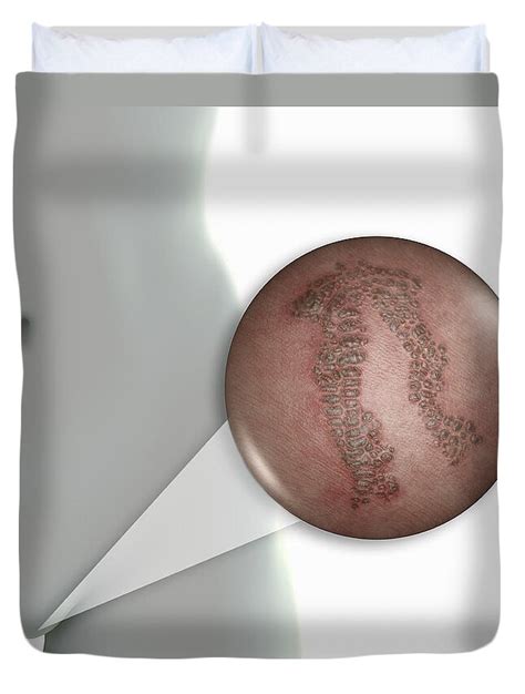 Female Genital Warts