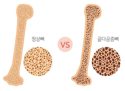 갱년기 여성의 건강관리와 골다공증 네이버 블로그