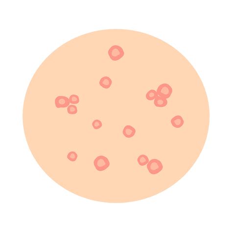 Borrelia Doktera