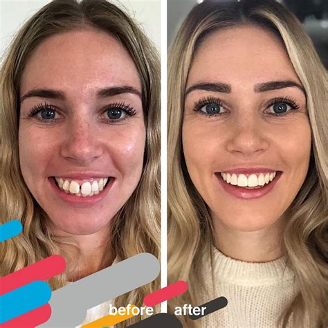 Invisalign Before And After Photosdr Jacquie Monroe Ortho