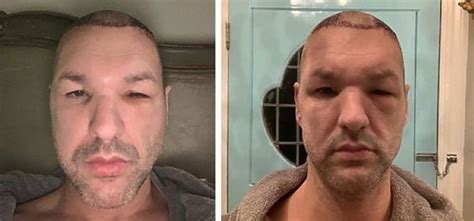 Hair Transplant After 1 Month Photos Results Side Effects