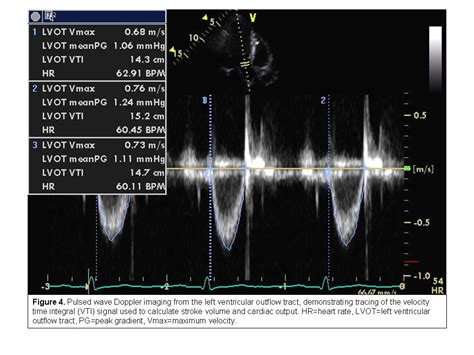 Use Of The Echocardiogram To Define The Presence Extent And Etiology Of Cardiac Dysfunction