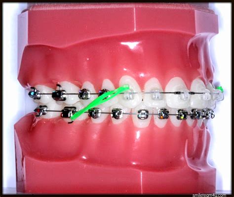 Poser Orthodontics Blog New Year Same Braces