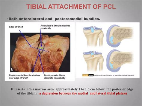 Arthroscopic Pcl Reconstruction Pptx