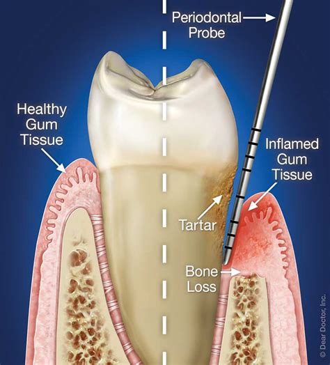 Periodontal Therapy Dr Charles Picchioni Bryn Mawr Pa