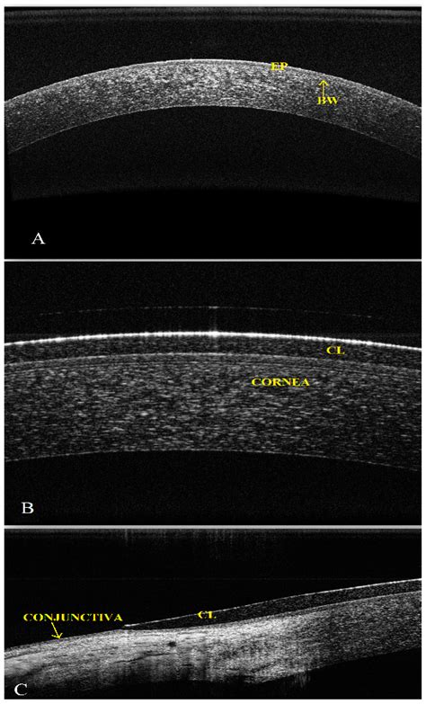 Optical Coherence Tomography Swept Source Generations Iloveden