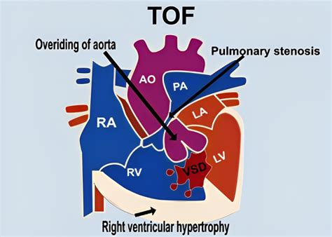 Tetralogy Of Fallot Tof Understanding Cardiac Challenges