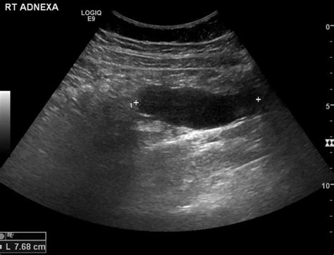 Appendix Mucocele Radiopaedia Malacards Integrated Aliases For Mucocele Of Appendix