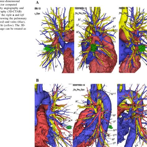 Pdf Anatomical Thoracoscopic Segmentectomy For Lung Cancer