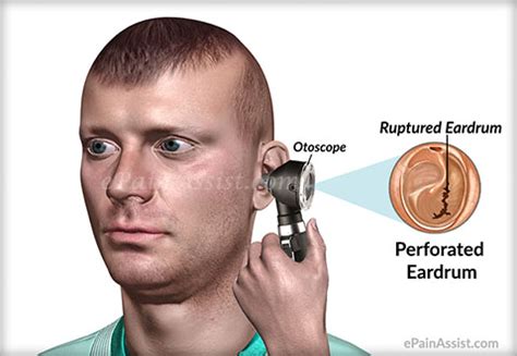Perforated Eardrum Punctured Or Ruptured Eardrum Causes Symptoms