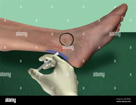 Posterior Tibial Nerve Block Artwork Of A Syringe Being Used To Inject A Local Anaesthetic To