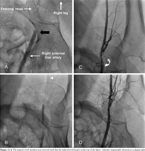 Figure 1 From Immediate Catheterization Laboratory Management Of Acute