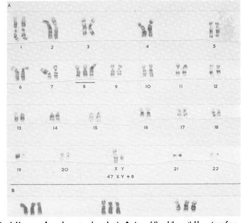 Figure 1 From Trisomy 18 Syndrome With An Unusual Karyotype Possible