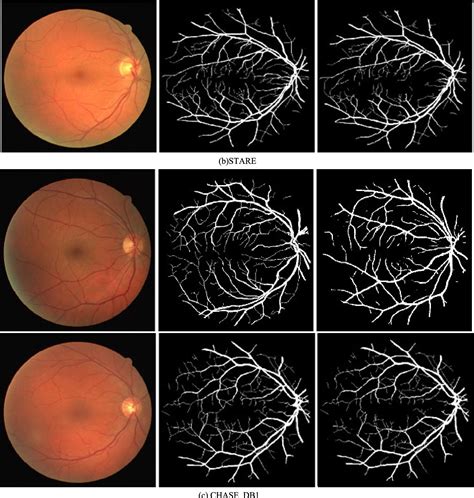 Figure 12 From Modified Depthwise Parallel Attention Unet For Retinal Vessel Segmentation