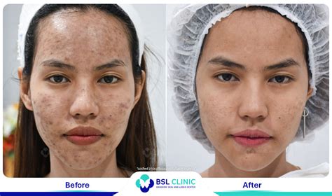 Brightening Treatments For A Natural Glow Youll Love