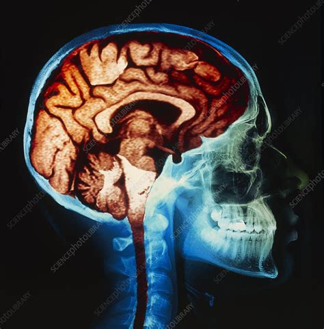 X Ray Brain