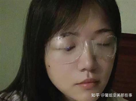 关于近视手术的问题，粉丝来稿，问到点子上了，希望回答没有失望 知乎