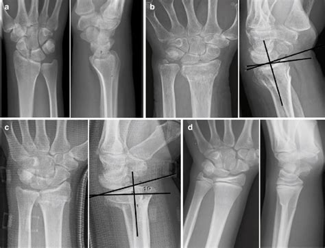 7 Examples Of Common Fractures And Injuries A Intra Articular Download Scientific Diagram