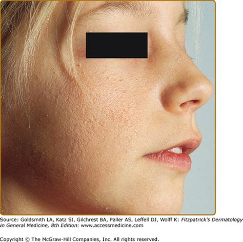 Atrophoderma Vermiculatum