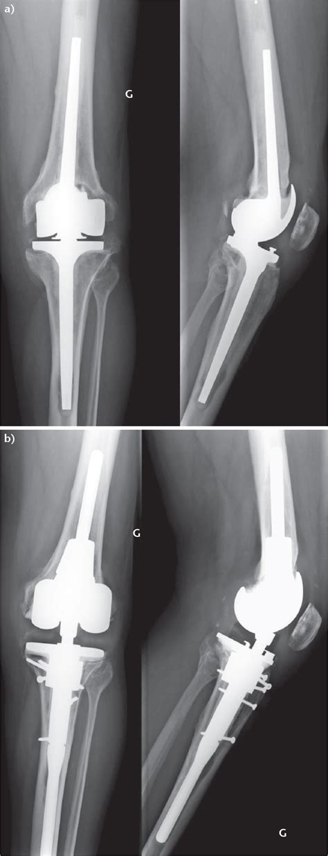 Hinged Knee Replacement After Revision