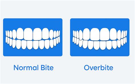 Overbite Vs Normal Bite Differences Symptoms And Treatments