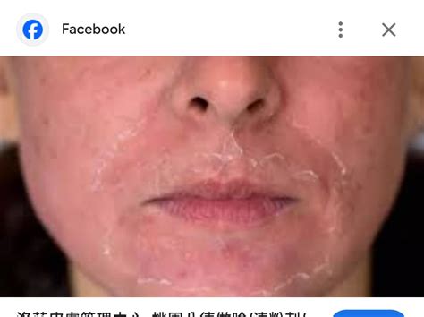 A醇臉脫皮求解！ 美妝板 Dcard