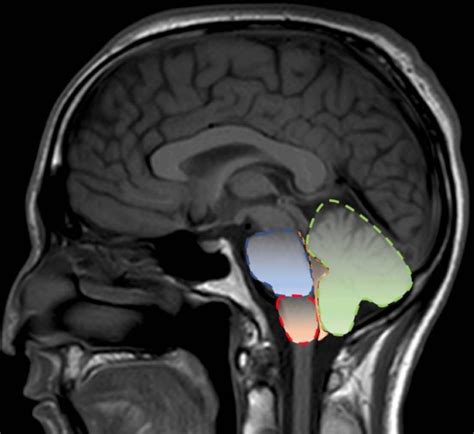 Rhomboencephalitis Practical Neurology