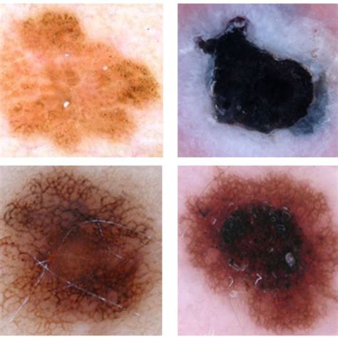 Examples Of Dermoscopic Images With Detection Error Download