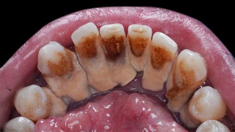 Huge Calculus Tartar Build Up Scaling Youtube