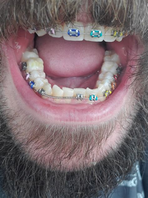 Got A Spring For Month 3 Braces