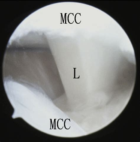Correction Of Severe Crossover Toe Deformity Of The Right Second Toe By