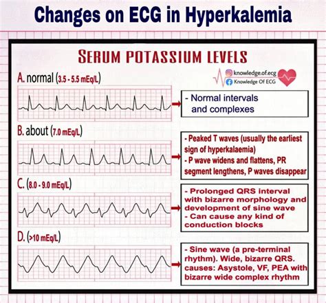 What Is Hyperkalemia🤔 Hyperkalemia Is Knowledge Of Ecg