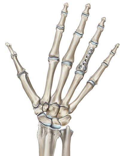Proximal Phalangeal Fractures Melbourne Hand Surgery