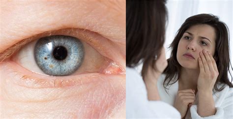 Botox Side Effects Droopy Eyelid
