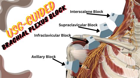 Usg Guided Brachial Plexus Block A Precision Approach