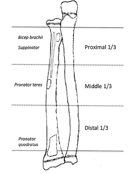 Fracture Radius And Ulna Shaft Diaphyseal Fractures