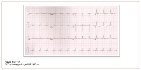 The Worst Case Scenario Of Electrolytes Imbalance Cardiac Arrest And Acquired Prolonged QT